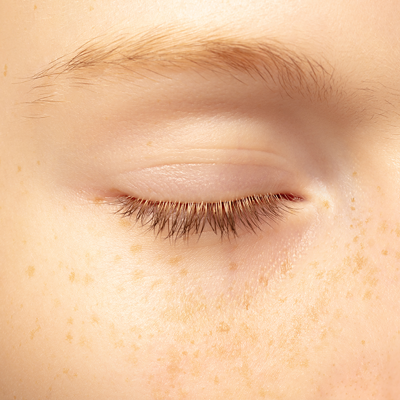 What Are Eye Freckles?