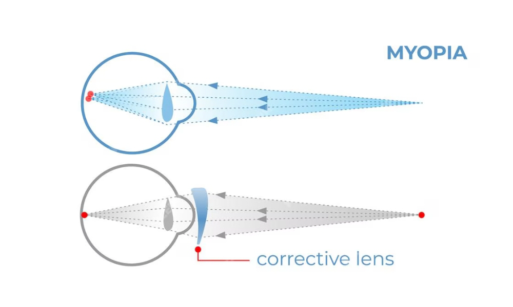 Look here for tips to prevent myopia